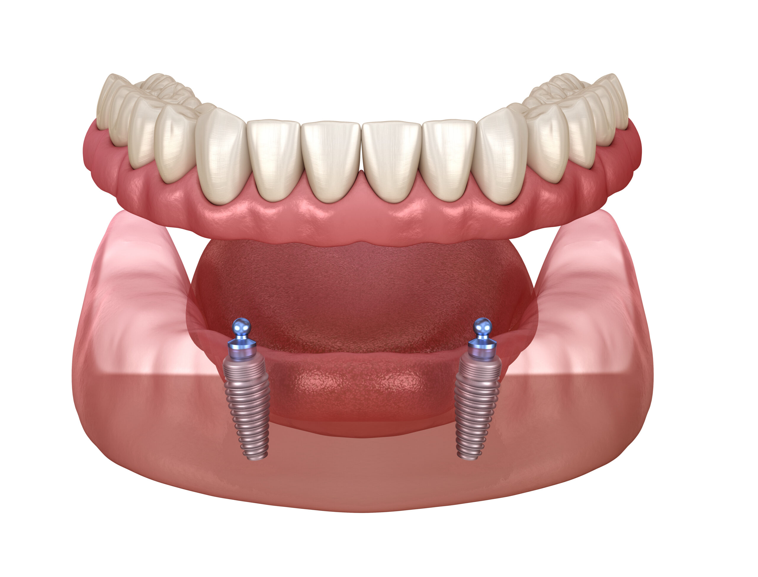 Over Denture - BAK Implant Studio