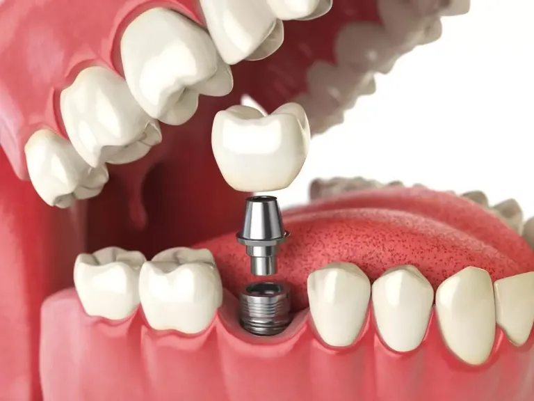 Same-Day Tooth Replacement - BAK Implant Studio